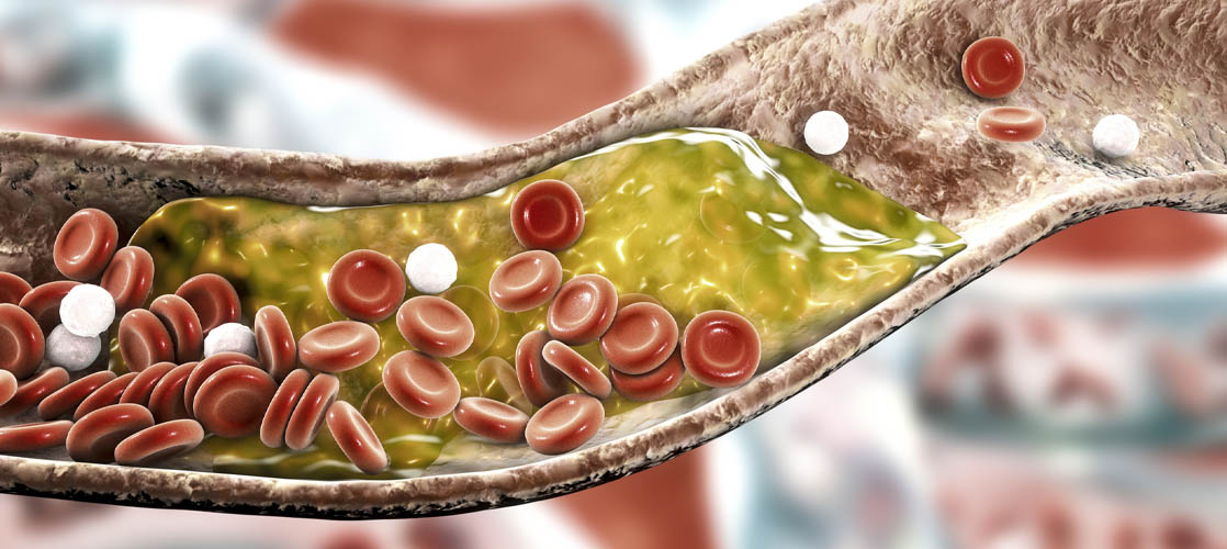 CRISPR Therapy for High Cholesterol? (Blog) | Eureka blog