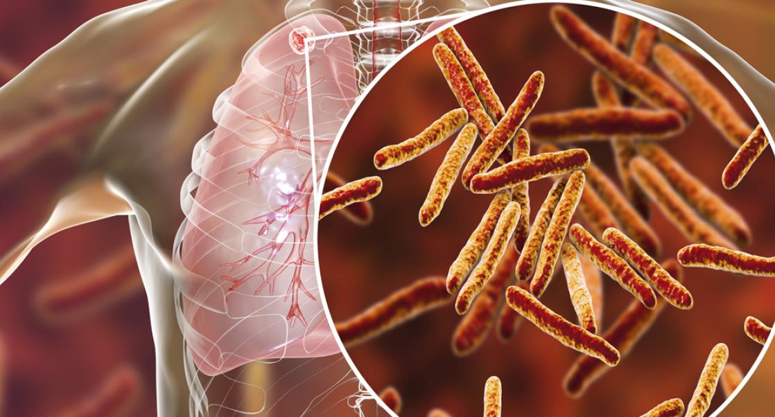 Radiologists Report Swelling From Vaccines Seen on Mammograms | Charles ...